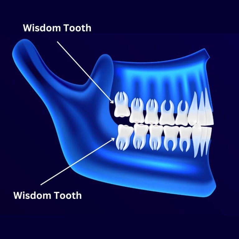 5 Signs That Your Wisdom Teeth Are Coming In