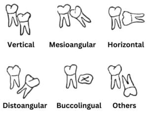 5 Signs That Your Wisdom Teeth Are Coming In